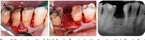 Figure 7 From Different Extra Coronal Restoration Options Of Hemisected