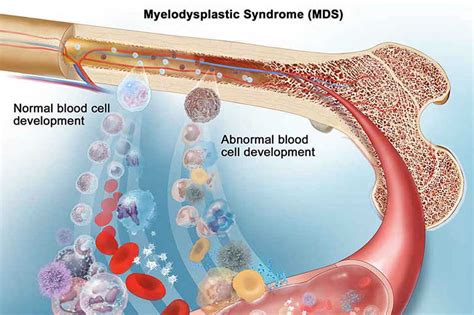 Mds Với Nguyên Bào Tăng Raeb 1 Raeb 2 Tổng Quan Và Hướng điều Trị