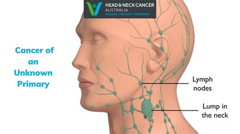 Lymph Nodes Neck Cancer