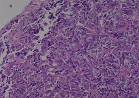 Novus Biologicals™ Human Ovary Tissue Microarray Cancer Slide Human