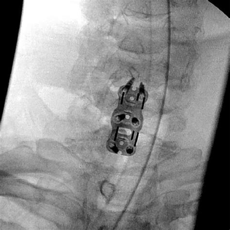 X Ray Cervical Spine Post Acdf Plate Placement Acdf Anterior Cervical