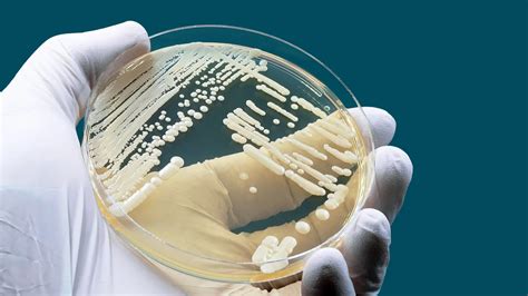 Fungal Meningitis Types Symptoms And Treatment