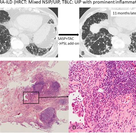 Case 2 A Hrct Showed A Mixed Nsip Uip Pattern With Ra Ild Which