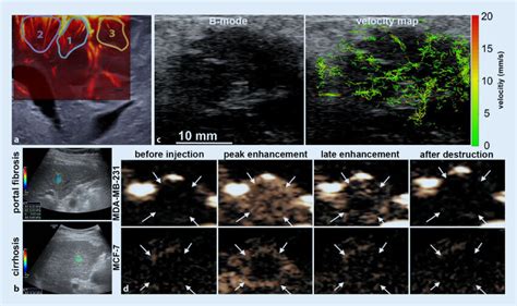8 A Ultrafast Doppler Image Of A Human Neonate Brain Overlaid On A