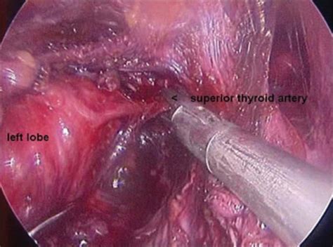 Endoscopic Thyroidectomy Our Technique Pmc