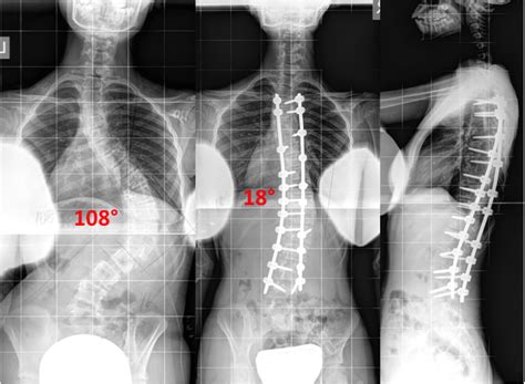 Vertebral Column Resection Scoliosis And Spine Associates