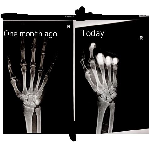 5th Metacarpal Broken Rbrokenbones 5th Metacarpal Broken Rbrokenbones