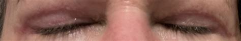 Upper Bleph Update Rplasticsurgery