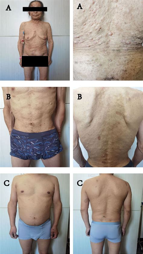 Frontiers Case Report Neurofibromatosis Type 1 Gastrointestinal
