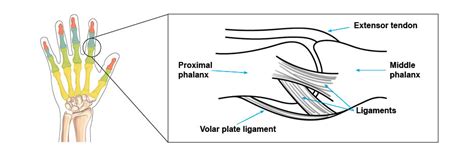Finger Pip Joint Injuries