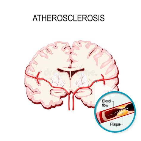 Cross Section Of The Brain Human Brain With Atherosclerosis Stock Vector Illustration Of
