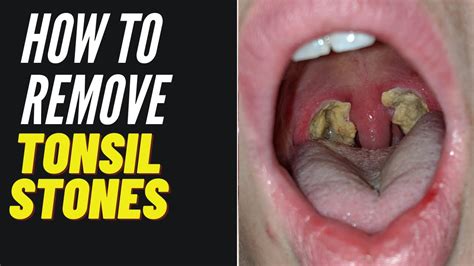 Tonsil Stone Removal Complitation How To Remove Tonsil Stones 2021