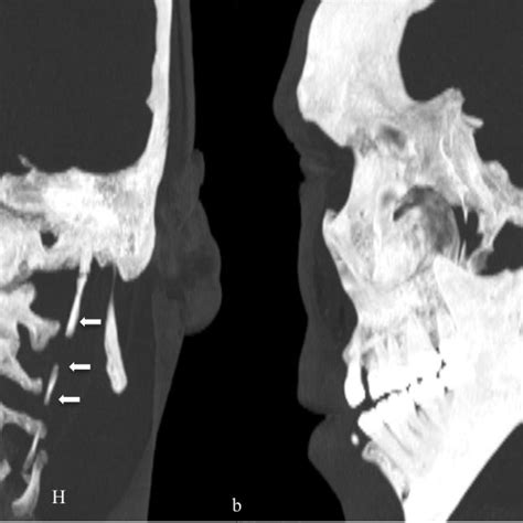 Ct Scan With 3d Volume Rendering Reconstruction Shows Elongated Styloid