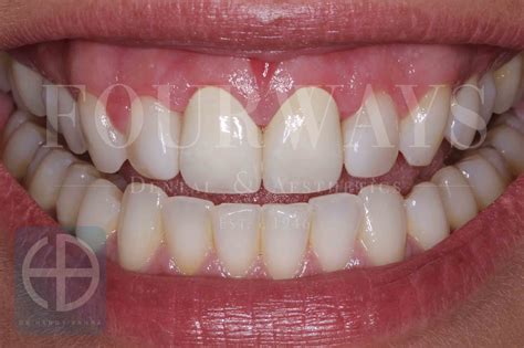 Porcelain Dental Crowns Gallery — Fourways Dental Clinic
