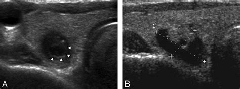 Thyroid Cyst Ultrasound Diagnosis Of Thyroid Nodules The Lancet