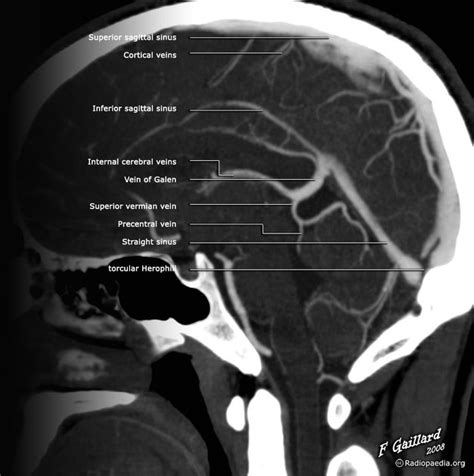 Sinus Rectus Anatomy Pacs