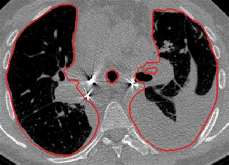 Segmentation And Image Analysis Of Abnormal Lungs At Ct Current Approaches Challenges And