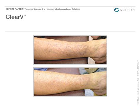 Clear V Vascular Laser Clinic 1 Auckland And Christchurch