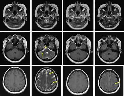 Familial Cerebral Cavernous Malformation Syndrome Radiology Cases