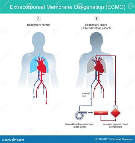 Ecmo Extracorporeal Membrane Oxygenation Structure Vector Illustration