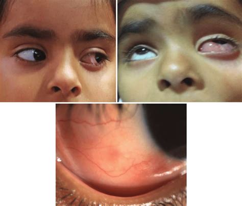 A Face Photograph Showing Redness Of The Left Eye B Showing Left