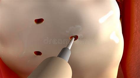 Laparoscopic Ovarian Drilling Stock Illustration Illustration Of