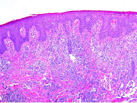 Papulosis Linfomatoide Hallazgos Clínico Patológicos En 18 Pacientes