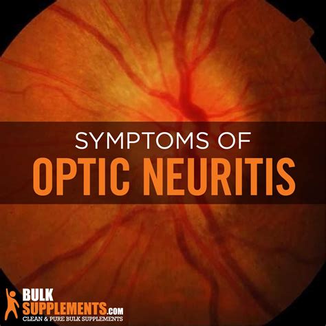 Optic Neuritis Treatment And Supplements For Optimal Vision