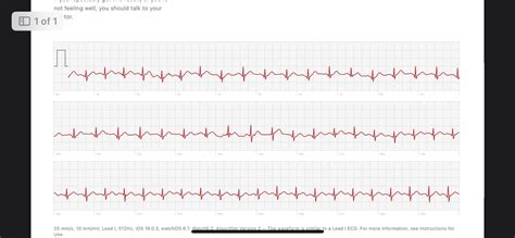 70 Year Old With Possible Aortic Root Dilation Surgery In My Future R Askcardiology