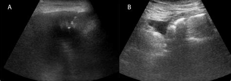 A Ultrasound Guided Paracentesis Was Performed With Return Of