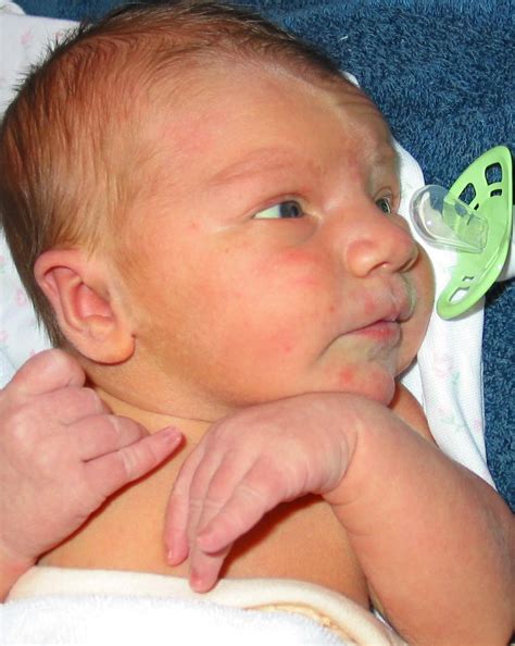 Erythema Toxicum Neonatorum Toxic Erythema Of The Newborn Toxic