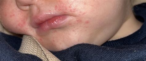 2 Year Old Red Spots Around Mouth