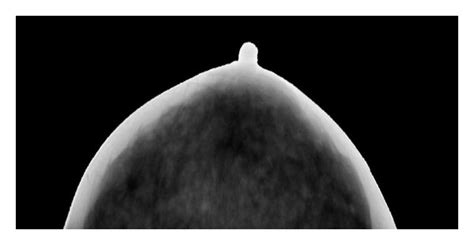 Comparison Of Contrast Enhancement Of Mammograms A Original