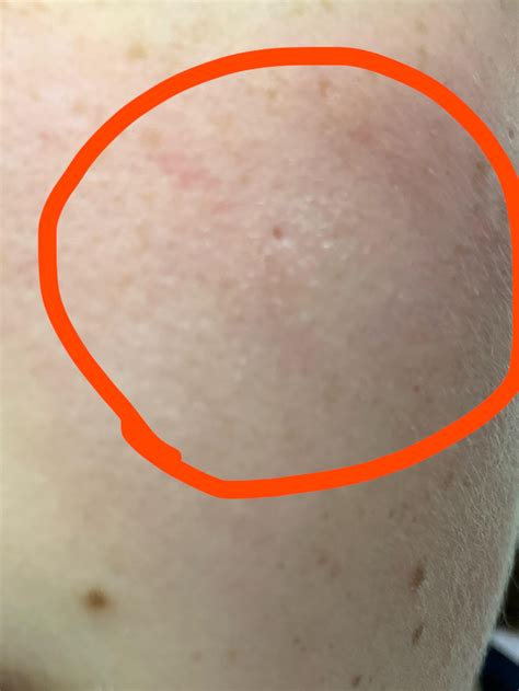 Small Hole In Skin On Face Disappears Sometimes Surrounded By Dry Skin Pretty Deep Cannot Be