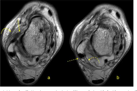 Figure 8 From Peroneus Brevis Split Tear A Challenging Diagnosis A