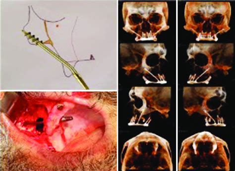 Extra Sinus Approach With Flap In Conjunction With Sinus Pathology