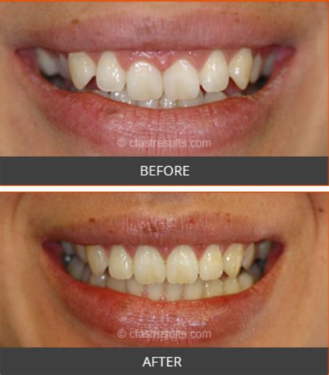 Cfast Aligners Twindent Dental Care