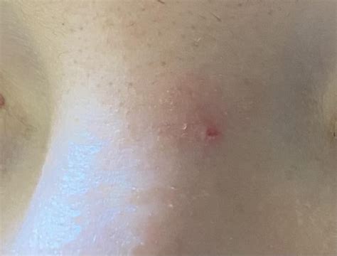 Acne Permanent Pimple Help Rskincareaddiction