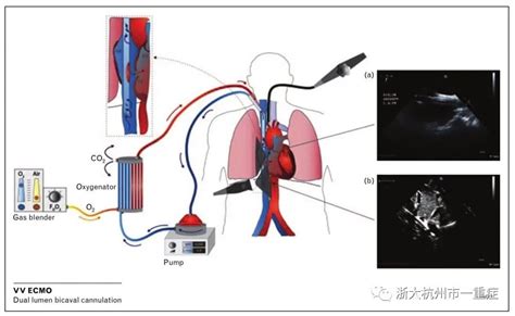 Ecmo的运行监测（上）杭州市第一人民医院
