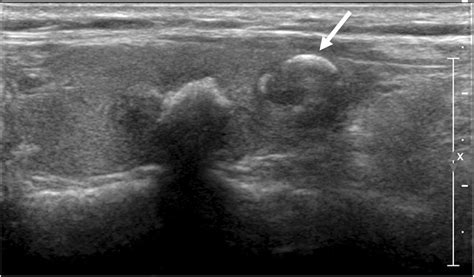 Echogenic Foci Associated With Malignancy 70 Year Old Female With