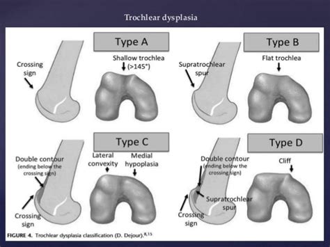 Patello Femoral Joint Mri