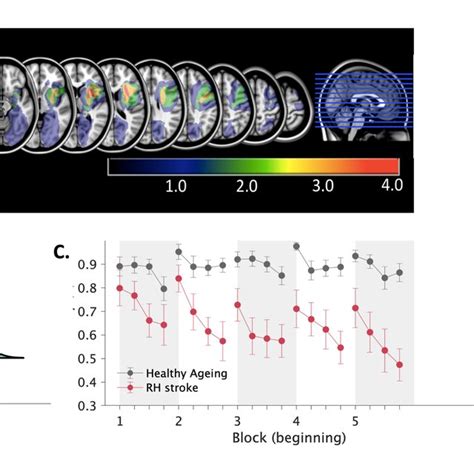 A Lesion Overlay For The Right Hemisphere Stroke Survivors