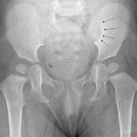 Same Patient As Figure 5 Ct Scan Showed Presence Of A Sequestrum A Download Scientific