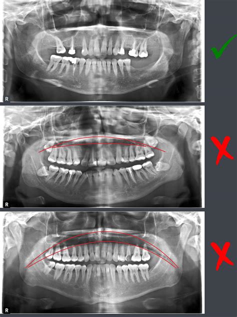 Effect Of Using Different Strips On Reducing The Most Common Error In