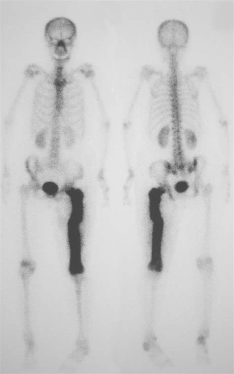 Radionuclide Bone Scan Showing Markedly Increased Uptake Affecting The