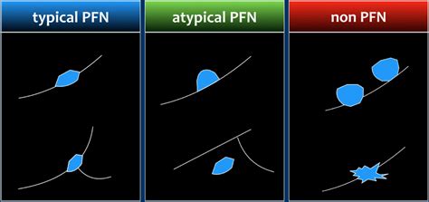 The Radiology Assistant Fleischner 2017 Guideline