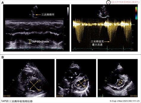 不可忽略的右心—《新英格兰医学杂志》综述右心心衰心肌药物 健康界