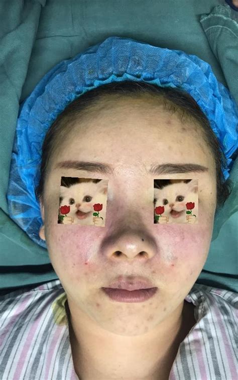 80后美女去打针，被人用生长因子兑麻药打在面部，导致眼睛都睁不开 知乎