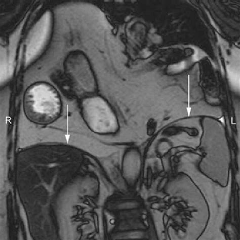 Chest X Ray Suggested Bilateral Hemidiaphragmatic Elevation Black