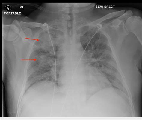 Chest X Ray Demonstrating Patchy Consolidative Opacities Affecting The